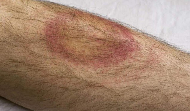Lyme, la enfermedad que puede provocar problemas mentales - KOHA.net