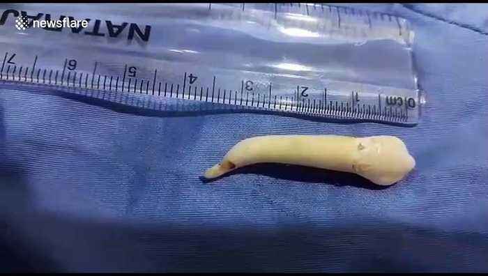 The Indian dentist claims to have extracted the longest tooth in the ...