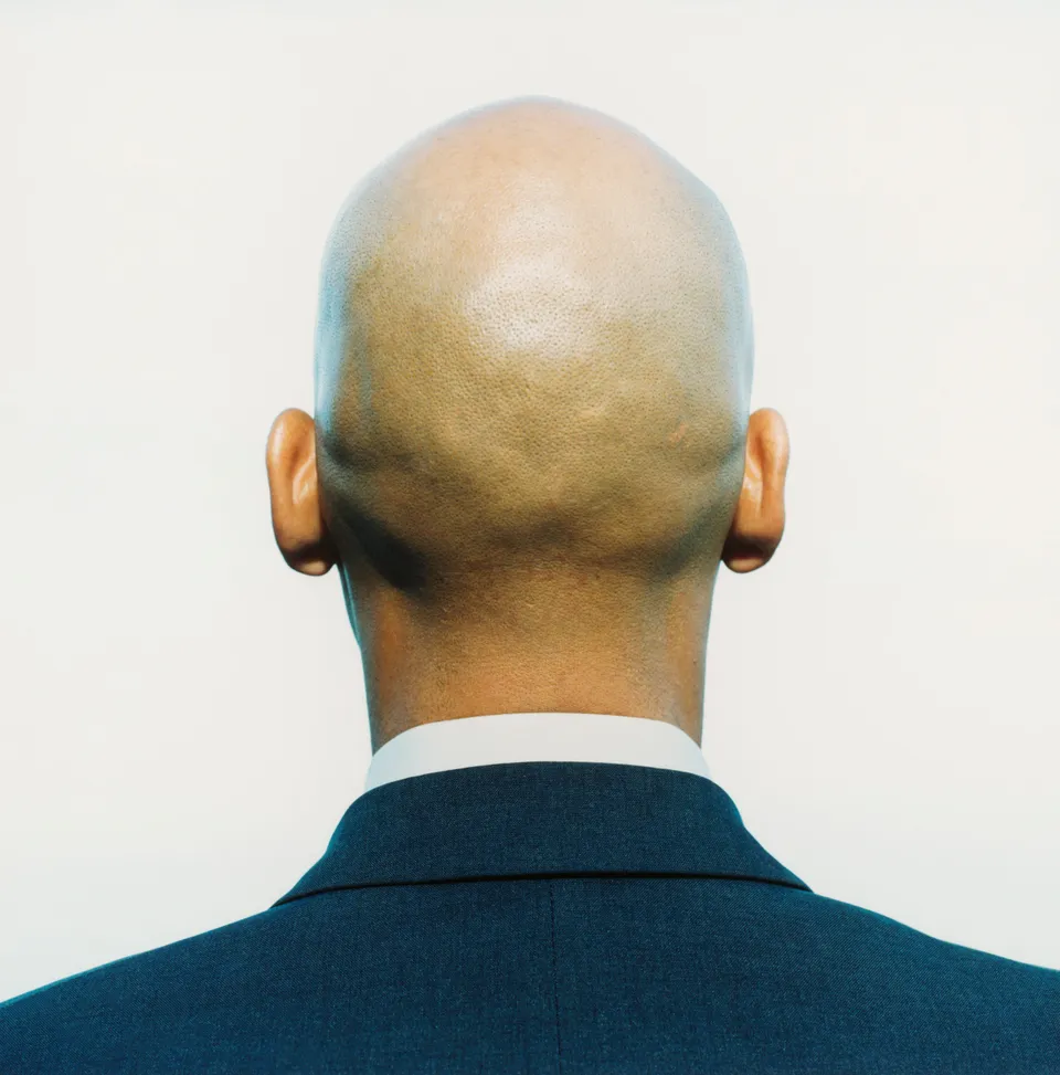 21 countries in the world with the most bald people - KOHA.net