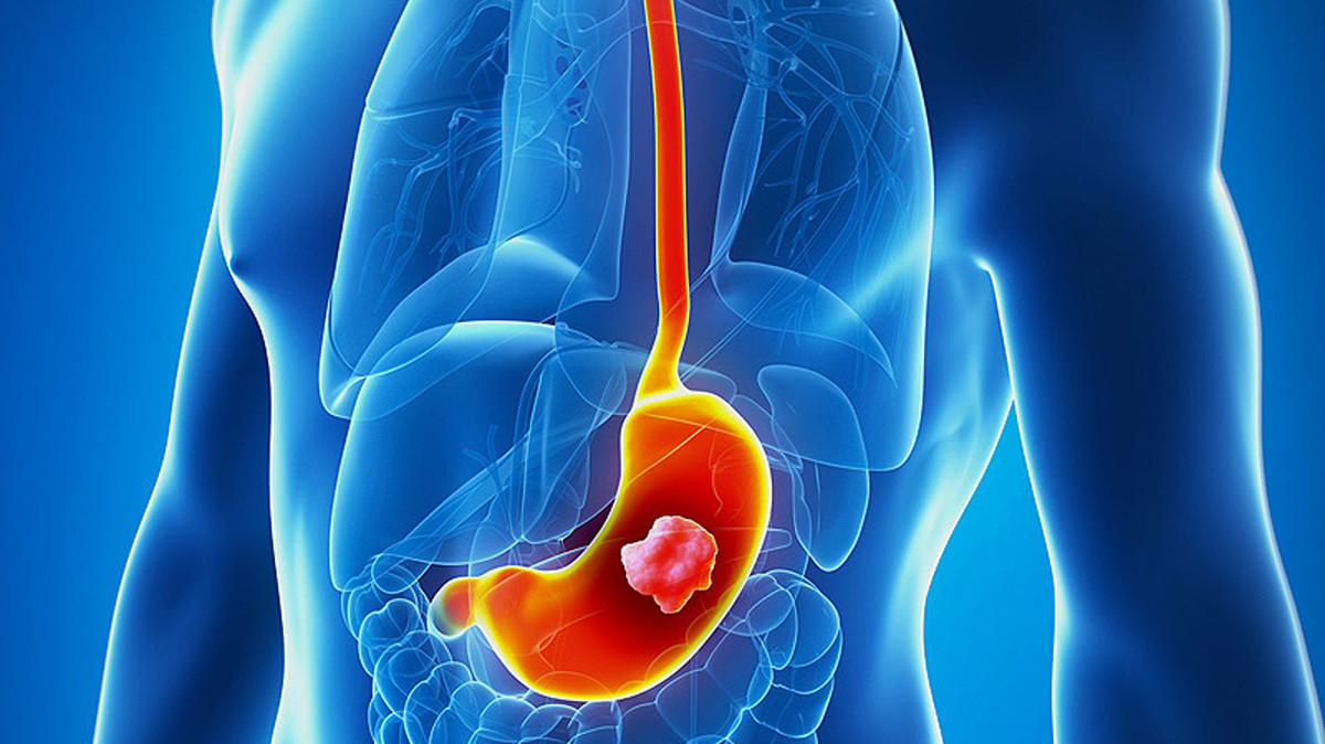 Was Magenprobleme über die Gesundheit aussagen - KOHA.net